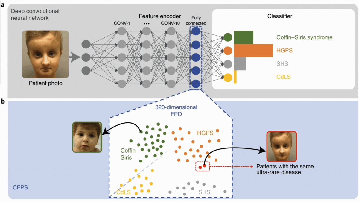 Face Recognition Identifies Childhood Genetic Diseases